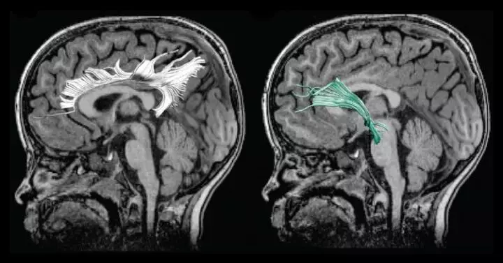 Genoemd als een van de oorzaken van agressie en hyperactiviteit bij kinderen