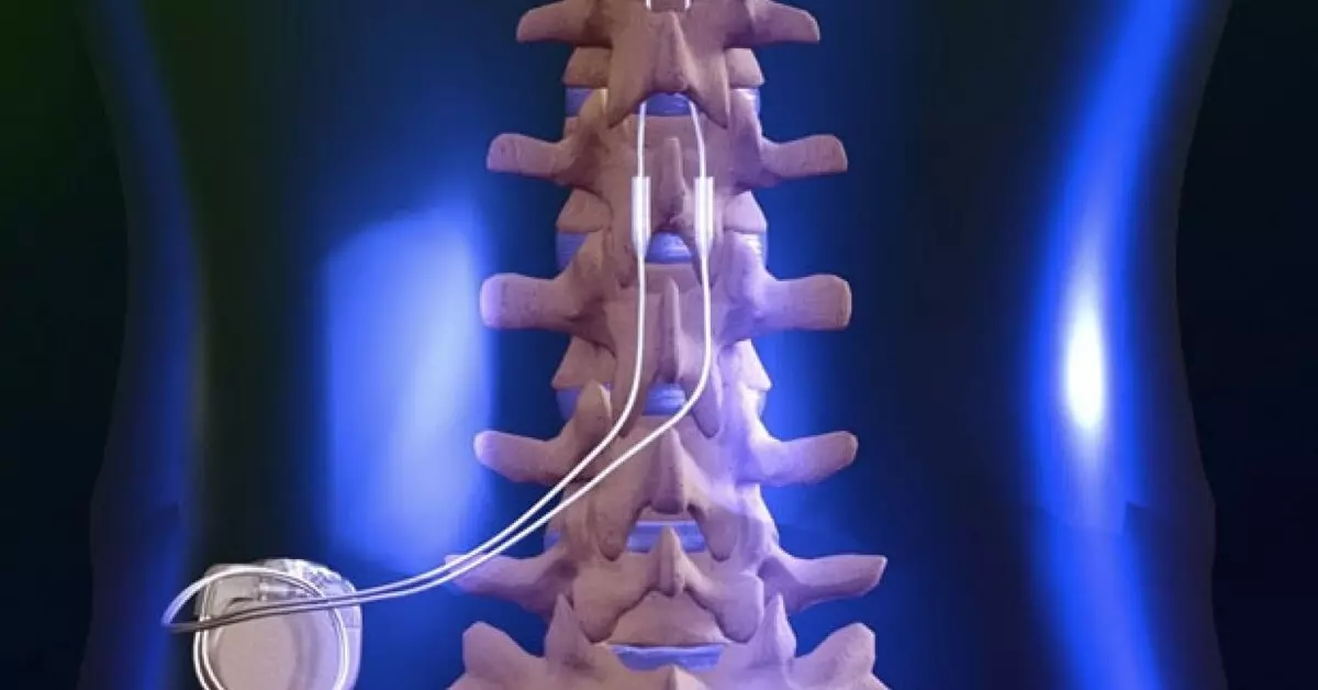 Ang spinal cord stimulation makatabang sa Parkinson's disease