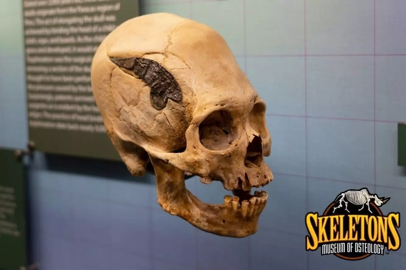 Hộp sọ Peru cổ đại được cấy ghép kim loại: thật hay giả? Đây là những gì các nhà khoa học nói