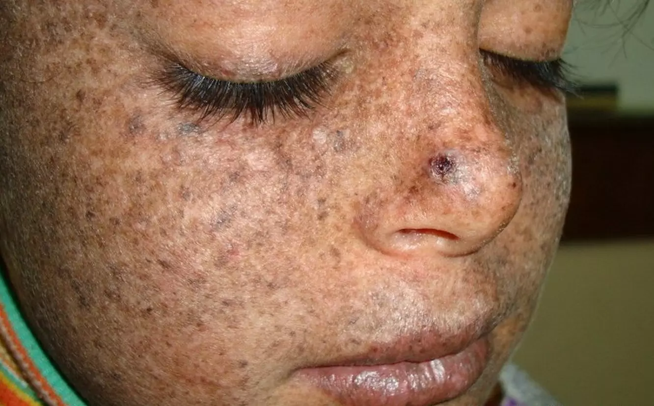 Xeroderma pigmentosa, auch bekannt als Vampirsyndrom, ist eine Krankheit, die eine akute allergische Reaktion auf ultraviolettes Licht, insbesondere Sonnenstrahlung, verursacht. Der Aufenthalt in der Sonne des Patienten droht ihm mit natürlichen Verbrennungen. Entwickelt sich leicht zu Hautkrebs.