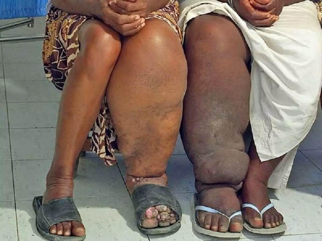 Elephantiasis, jew elephantiasis, hija żieda fid-daqs ta 'kwalunkwe parti tal-ġisem, ġeneralment ir-riġlejn, minħabba t-tkabbir tal-ġilda u tat-tessut taħt il-ġilda. Spiss ikkawżat min-nematodu parassitiku Brugia malayi. S'issa, qed jirrispondi tajjeb għat-trattament.