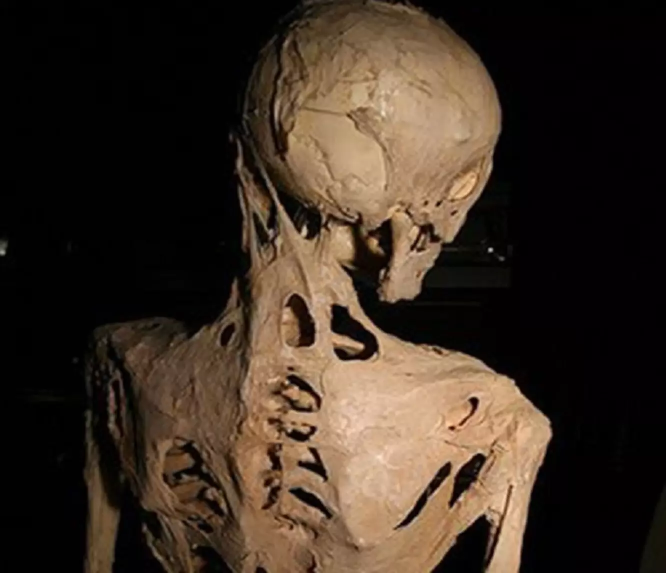 Fibrodysplasia ossificans progressiva, li normalment titqassar għal FOP, hija marda ġenetika severa li fiha t-tessuti rotob ta 'persuna gradwalment isiru għadam. Ir-rarità tal-marda tikkomplika ħafna l-ġlieda kontriha.