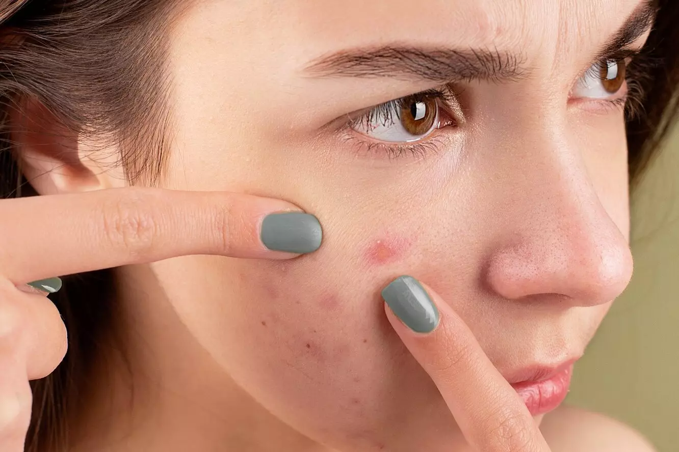 5 ziekten die onze huid kan signaleren