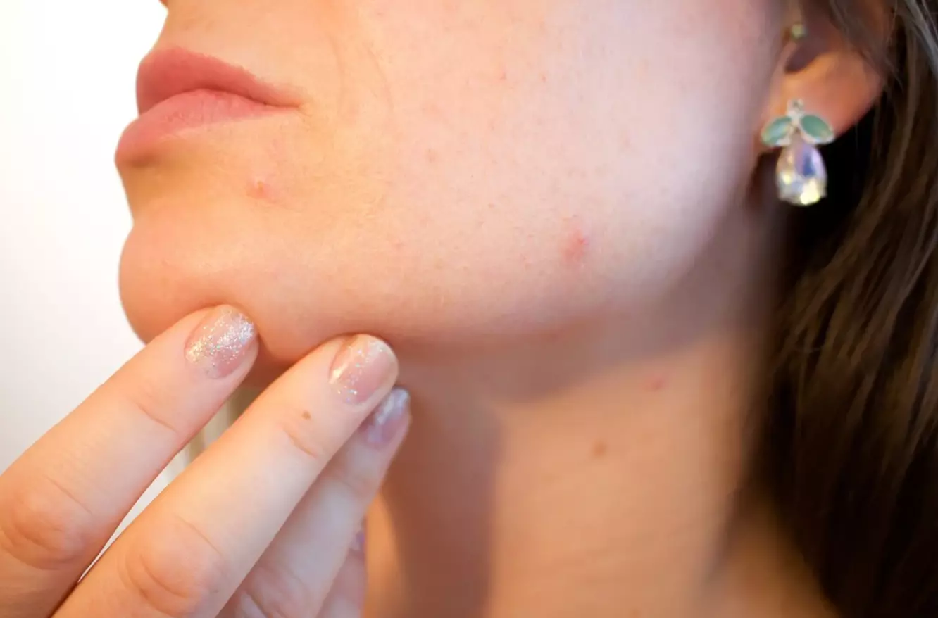 Kõige levinumad nahaprobleemid, mis tekivad organismi talitlushäirete tõttu 218558_5