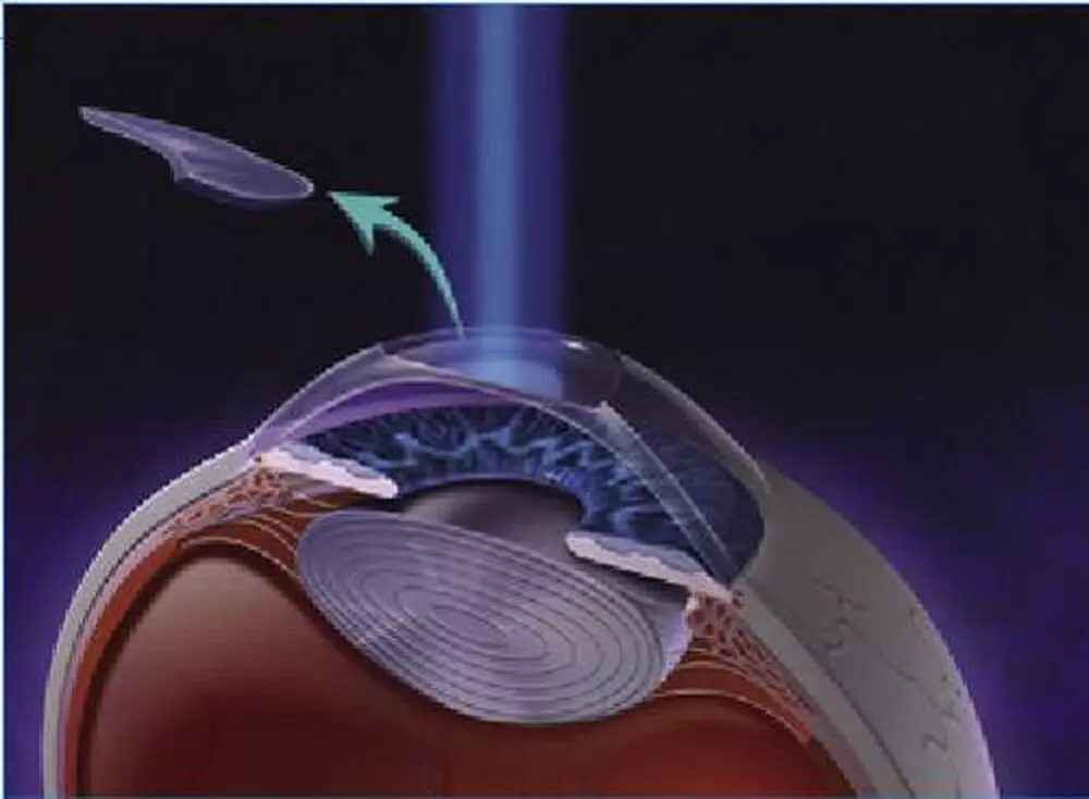 photorefractive keratectomy ຫຼື ablation (evaporation) ຂອງສ່ວນຫນຶ່ງຂອງຜິວ corneal ທໍາອິດ, ຊັ້ນເທິງຂອງຈຸລັງ (epithelium) ຖືກໂຍກຍ້າຍ, ຫຼັງຈາກນັ້ນ myopia, hyperopia ຫຼື astigmatism ຖືກແກ້ໄຂດ້ວຍ excimer laser n ຈໍານວນການດໍາເນີນງານປະຕິບັດ: 80,000 ໃນສະຫະລັດ. ຄໍາຮ້ອງທຸກ: ບໍ່ຄ່ອຍ - ຟັງແລະຫຼຸດລົງ acuity ສາຍຕາໃນລະຫວ່າງການປິ່ນປົວ. ລາຄາ: $299 ຫາ $2200 ຕໍ່ຕາ