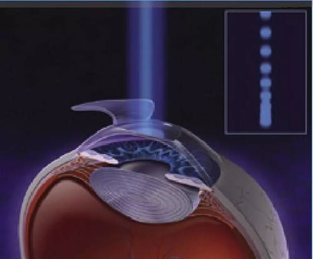 Laser-Keratomileusis. Ein Patchwork-Schnitt wird mit einem Mikrokeratom oder Femtosekundenlaser durchgeführt. Die Klappe wird zurückgezogen und der Excimer-Laser wird verwendet, um Kurzsichtigkeit, Weitsichtigkeit oder Hornhautverkrümmung zu korrigieren. Anzahl der durchgeführten Operationen: 4,1 Millionen in den USA Beschwerden: Unterkorrektur oder Überkorrektur, Verlust der Sehschärfe Kosten: 299 bis 2200 US-Dollar pro Auge