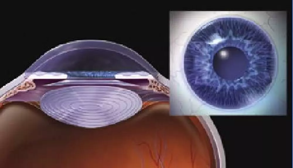 لنز استار. کاشت لنز داخل چشمی در جلوی لنز برای تصحیح نزدیک بینی تعداد عمل های انجام شده: 40000 عمل در سراسر جهان، حدود 1400 مورد در تست FDA شکایات: نادر - برداشتن به دلیل اندازه، افزایش فشار داخل چشمی و تماس های آسیب زا با لنز هزینه: نامشخص، تکنیک تحت بررسی FDA