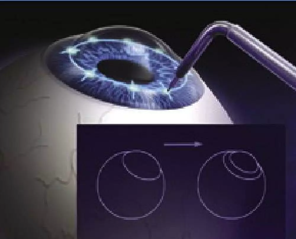 Versiones. El lente se une al iris para corregir la miopía. Número de operaciones realizadas: 150.000 en todo el mundo, unas 2.000 en pruebas FDA. Quejas: Raro - Interrupción y remoción del iris debido al tamaño Costo: Desconocido, técnica bajo revisión de la FDA