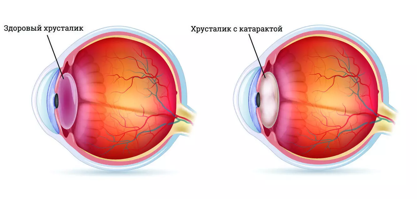 Cataract ndi matenda a maso okha okhudzana ndi ukalamba omwe pakali pano akuyenera kuthandizidwa ndi ma radiation otsimikizika.