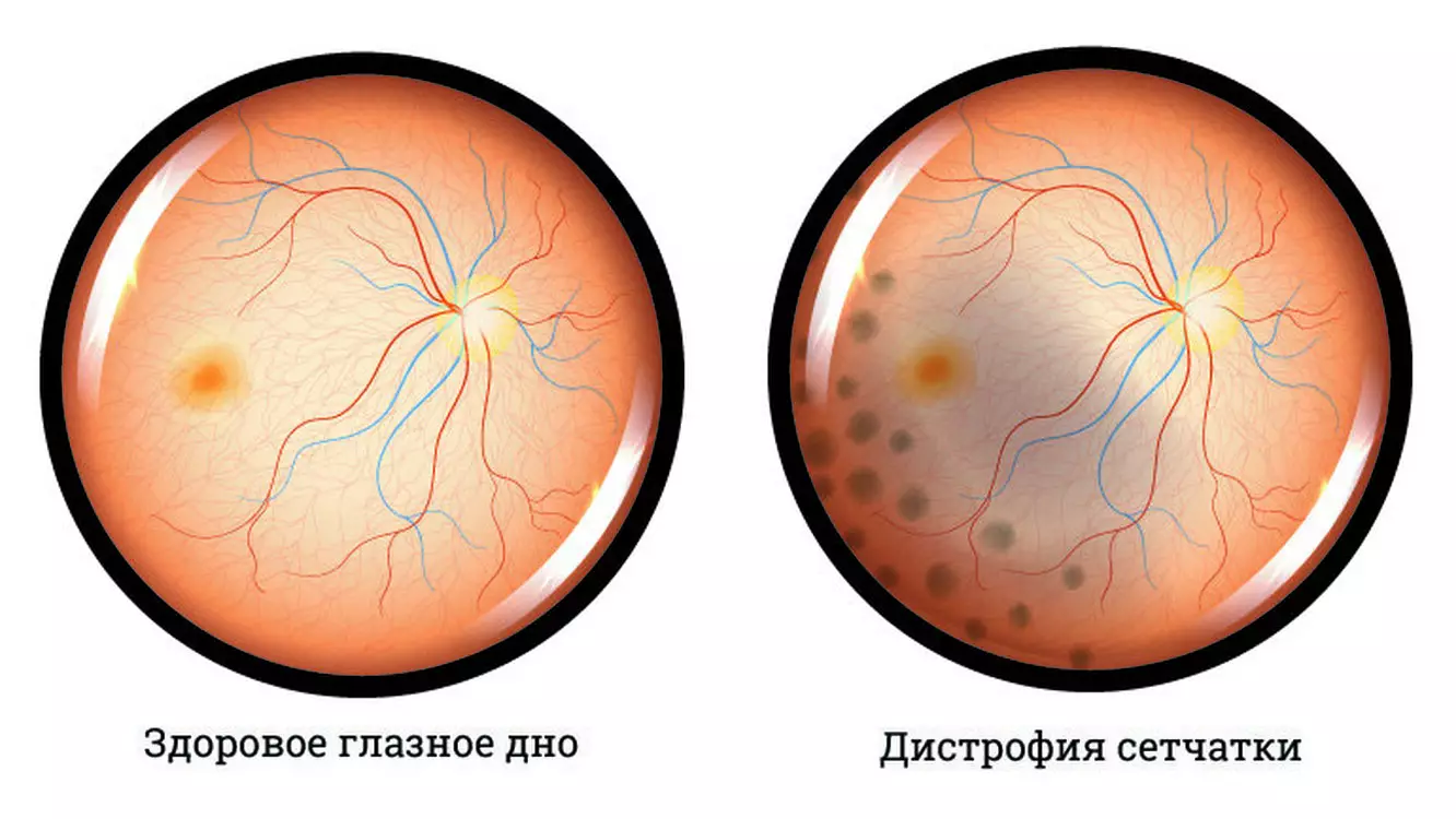 Age-related macular degeneration of the retina is one of the most difficult to tolerate age-related vision diseases.