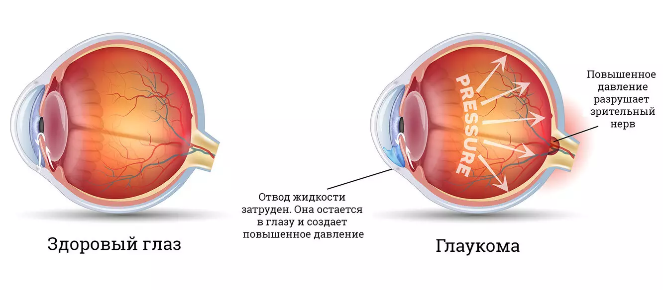 Mchoro wa kina wa ugonjwa mwingine wa jicho unaohusiana na umri - glaucoma.