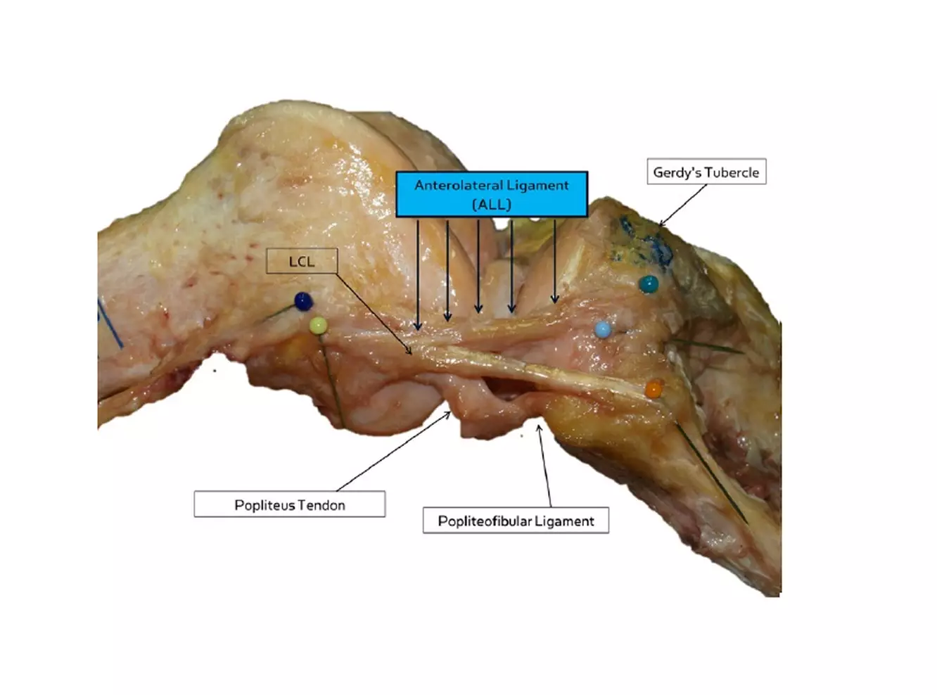 Déi blo Inskriptioun anterolateral Ligament weist e nei opgemaache Bande un