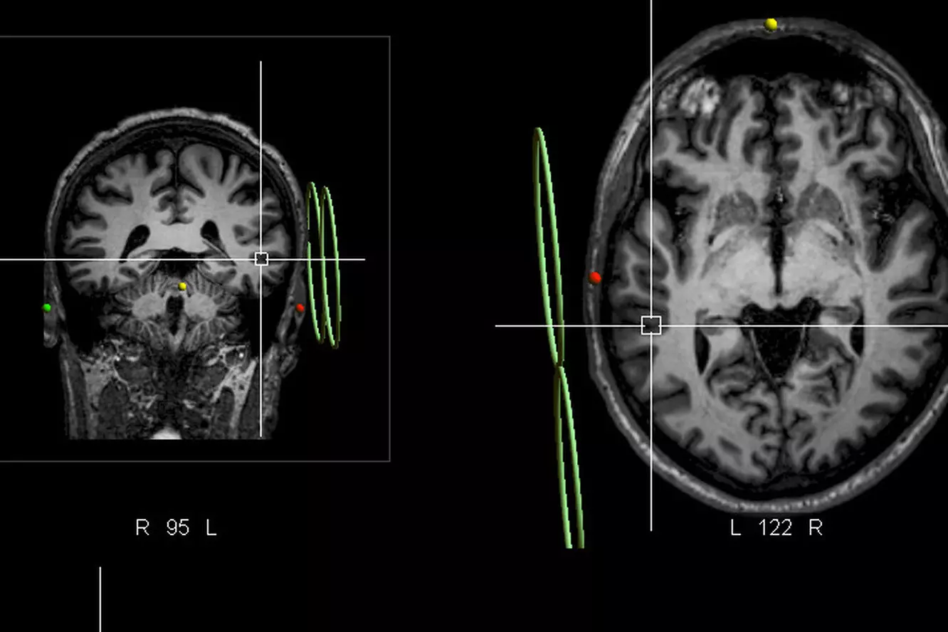 Bereich im Gehirn von Schizophrenen gefunden, wo gespenstische „Stimmen“ gebildet werden