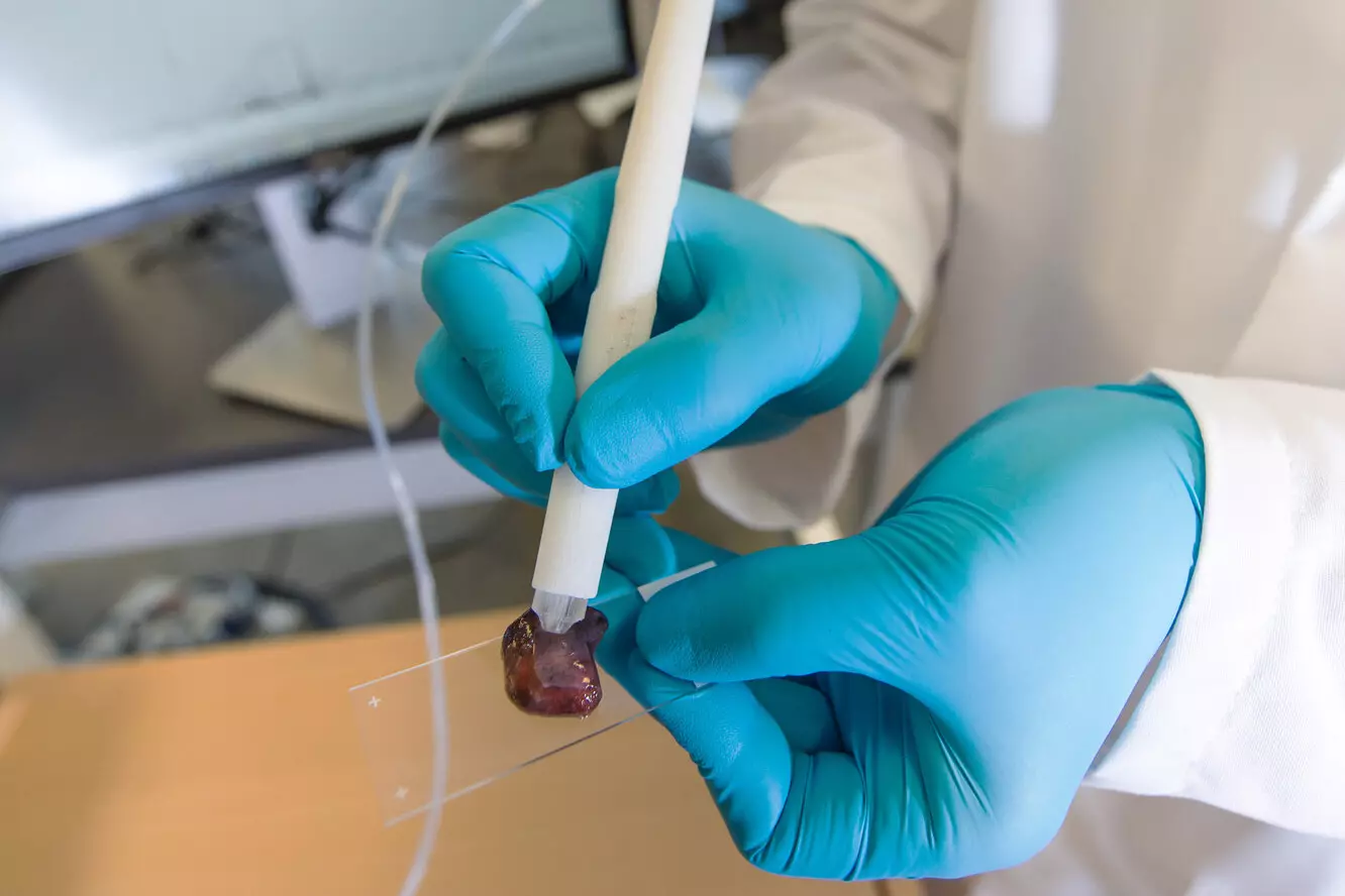Vyvinuté „pero“, ktoré odhalí rakovinu za 10 sekúnd