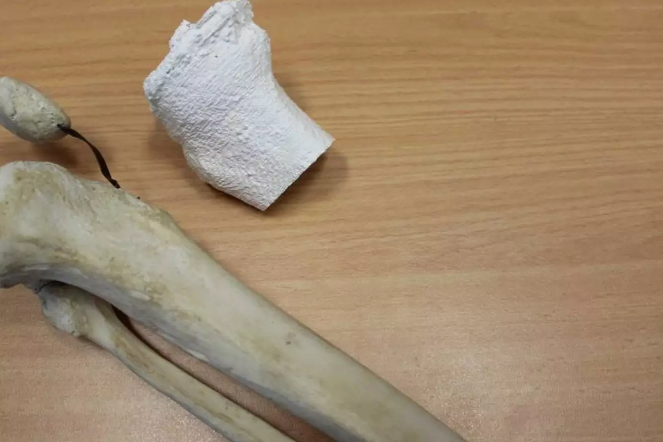 3D štampana kost noge uspješno implantirana u čovjeka