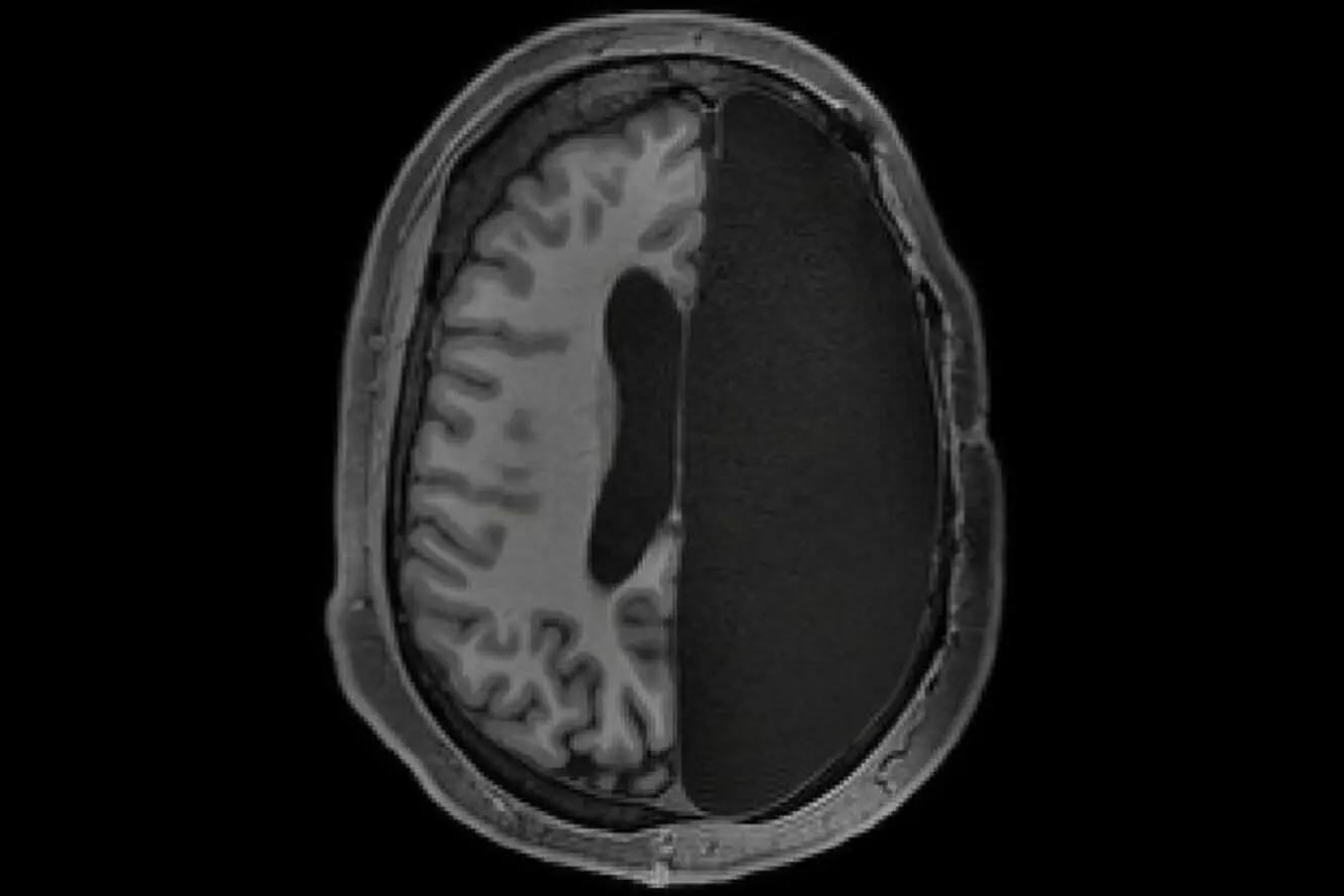 La metà del cervello umano si è rivelata non peggiore dell'intero