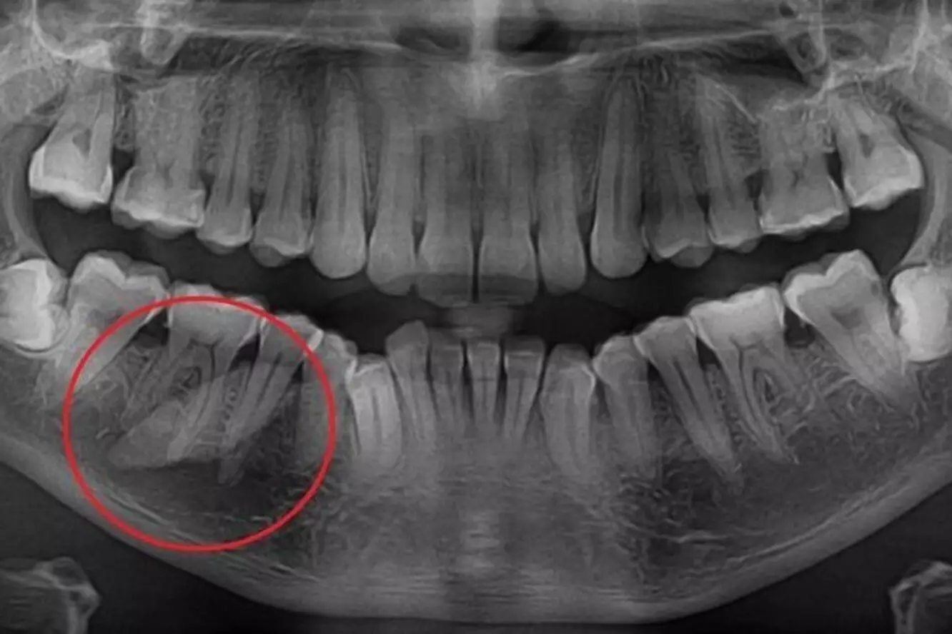 Uma enorme pedra salivar cresceu na gengiva de um homem