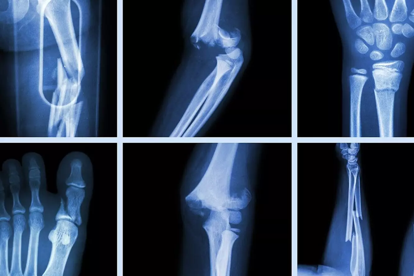 A startup danesa comeza a imprimir próteses óseas personalizadas
