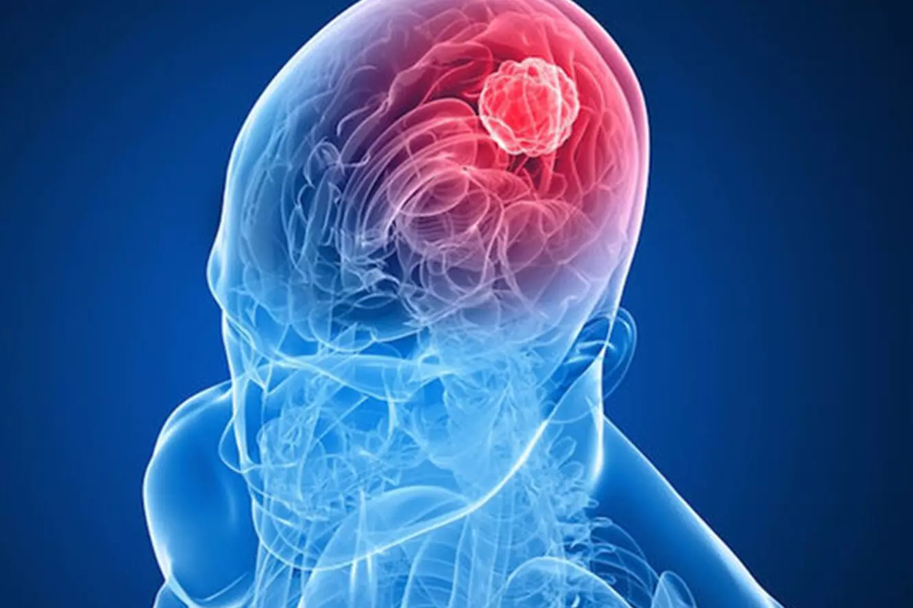 ساینس پوهانو د دماغ سرطان په وړاندې بله جګړه وګټله