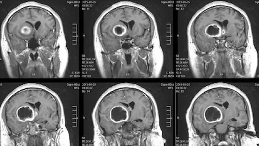Obrázky mozgového nádoru - glioblastóm