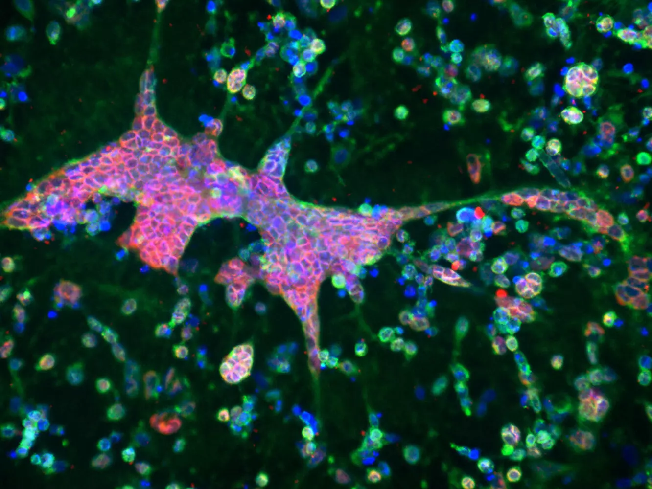 Ontwikkeling van de ziekte van Alzheimer in bioengineered hersenweefsel