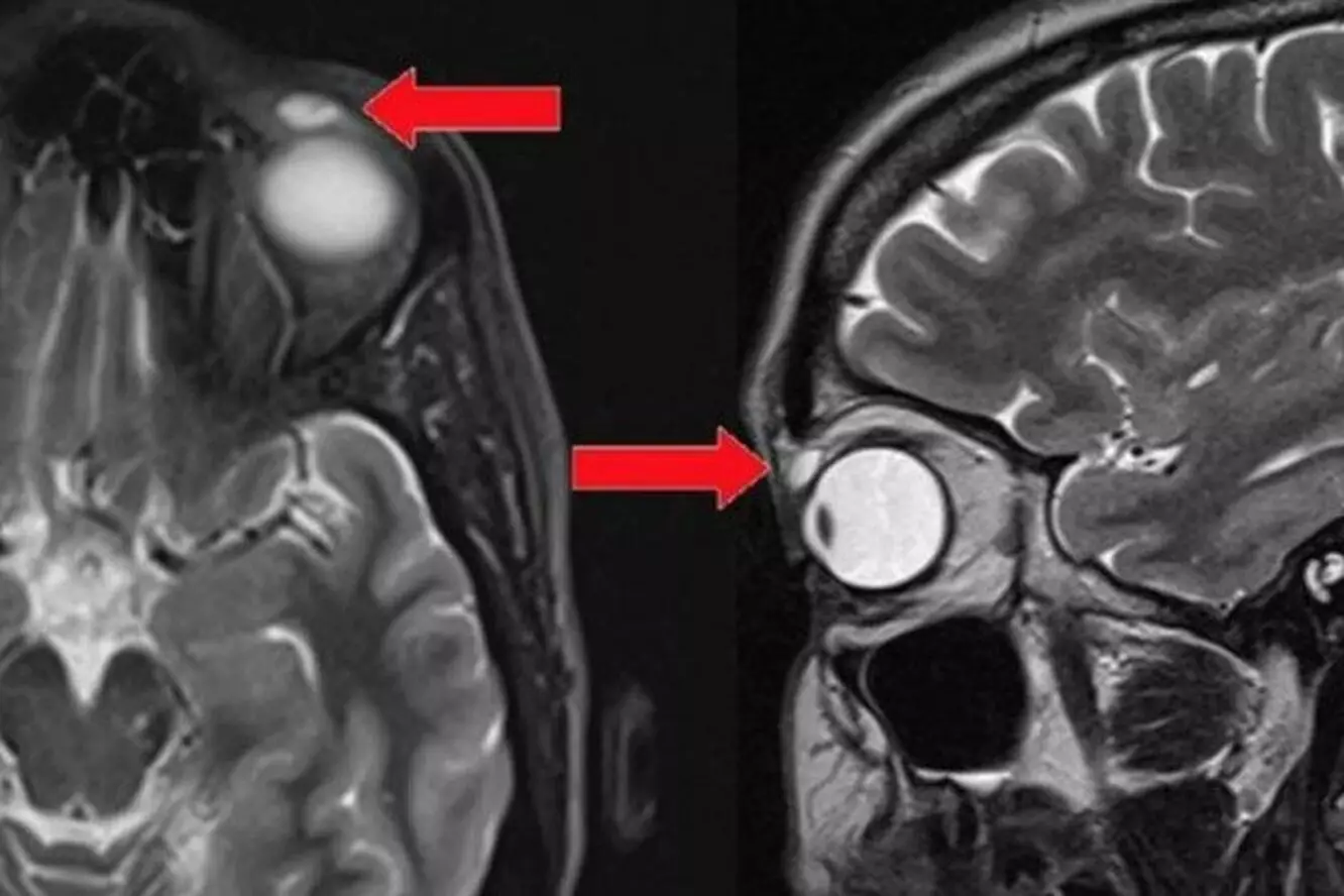 La donna non sospettava che qualcosa di strano si nascondesse nei suoi occhi da 28 anni