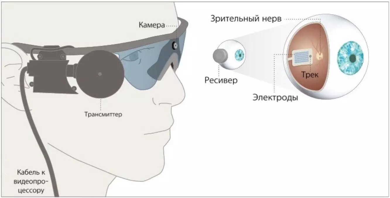 피질 이식 기술은 시각 장애인이 세상을 볼 수 있게 합니다. 384016_3