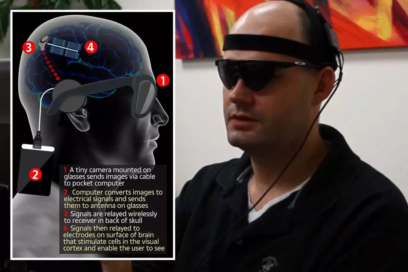 피질 이식 기술은 시각 장애인이 세상을 볼 수 있게 합니다. 384016_7
