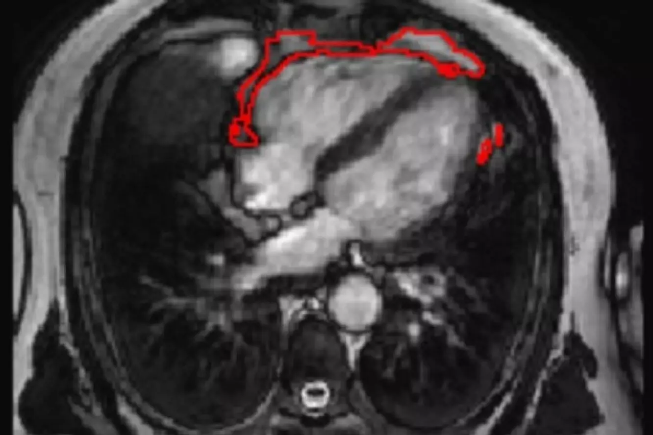 Sun'iy intellekt yurak atrofidagi yog'ning xavfli darajasini aniqlashni o'rgandi 385820_2