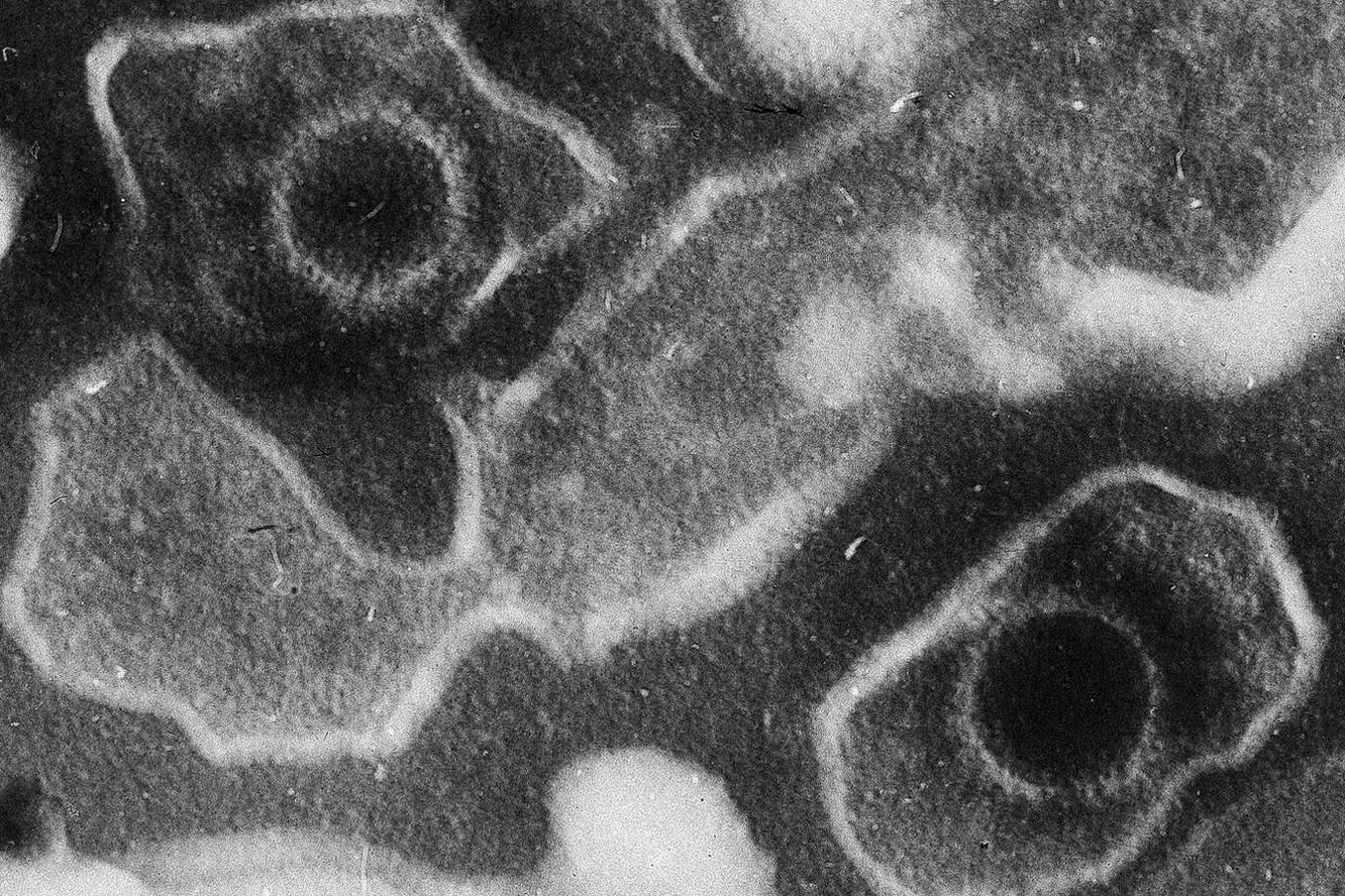 Plaši izplatīts vīruss var izraisīt multiplo sklerozi