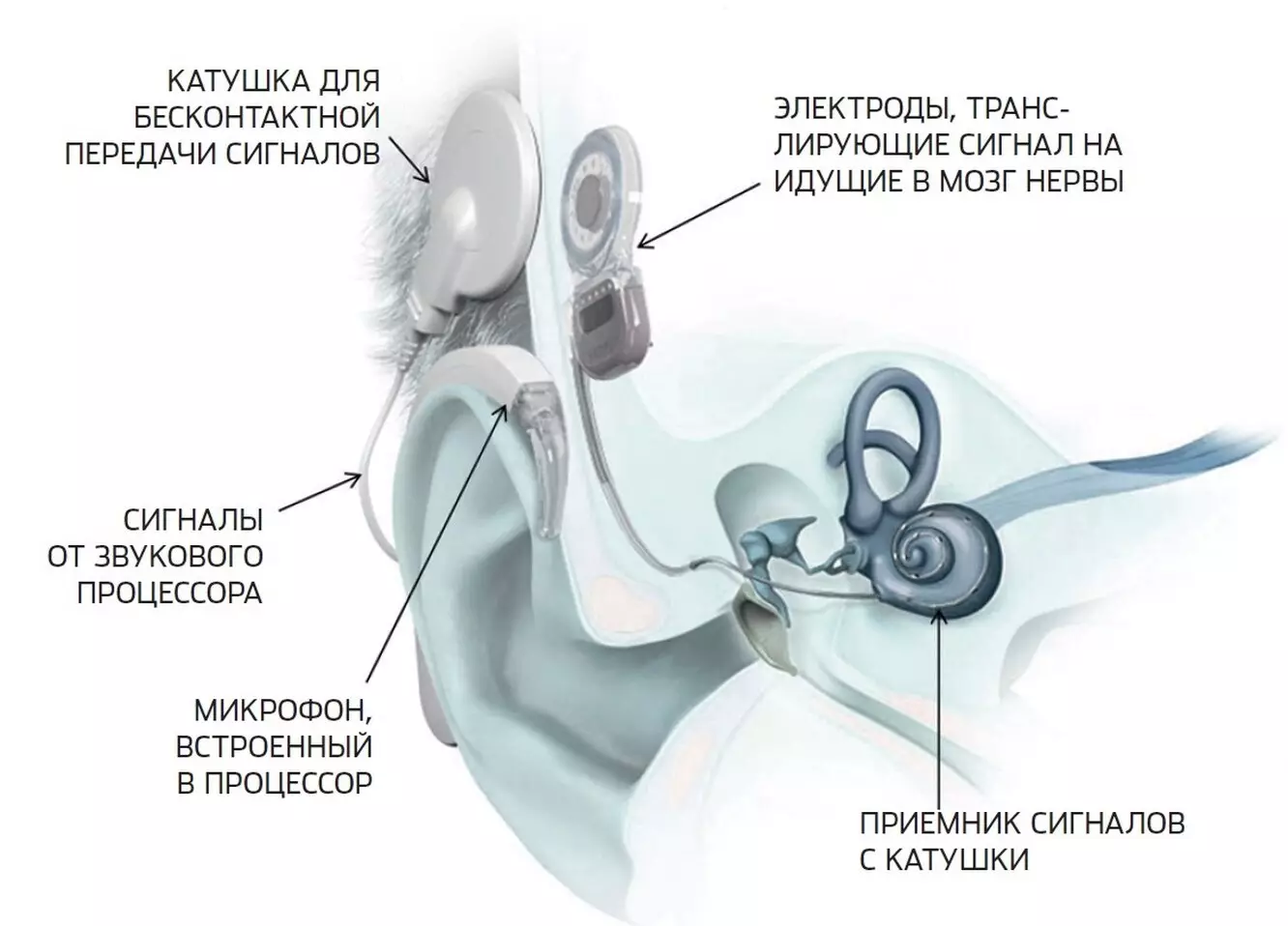 Awọn prostheses ọpọlọ: kini wọn ati bawo ni wọn ṣe n ṣiṣẹ? 395440_3