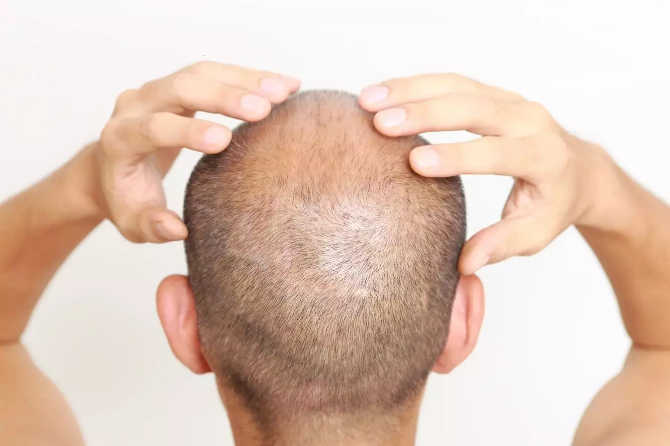 O nouă modalitate de a combate chelia masculină: oamenii de știință au descoperit o moleculă care este responsabilă pentru creșterea părului