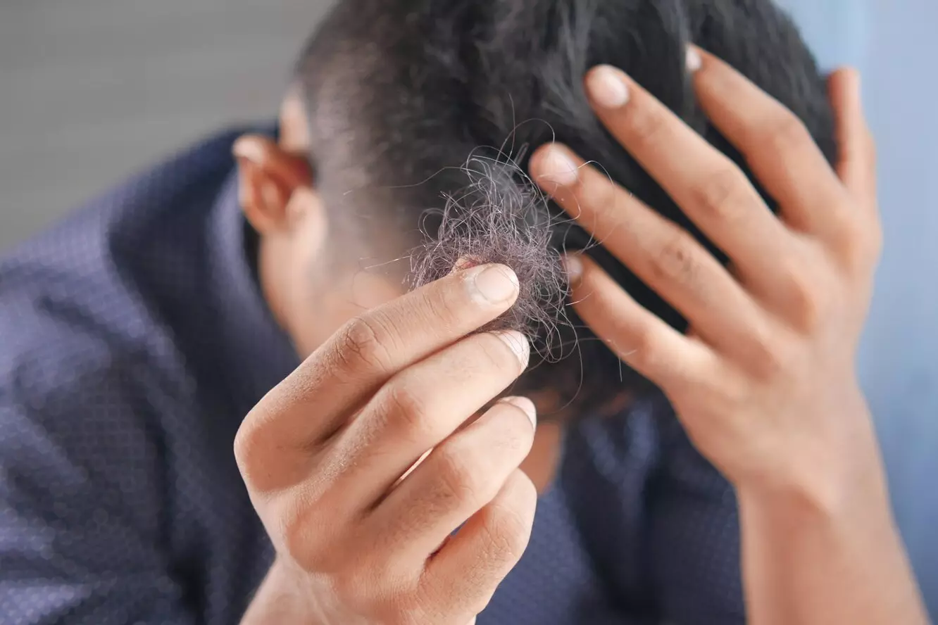 Chelie la bărbați: oamenii de știință au găsit o nouă modalitate de a combate căderea părului 400675_2