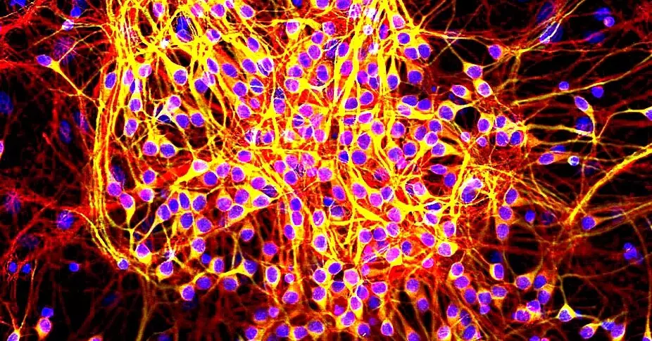 De stúdzje liet sjen hoe't it tau-protein feroaret yn 'e sykte fan Alzheimer. It kin helpe by de behanneling fan 'e sykte