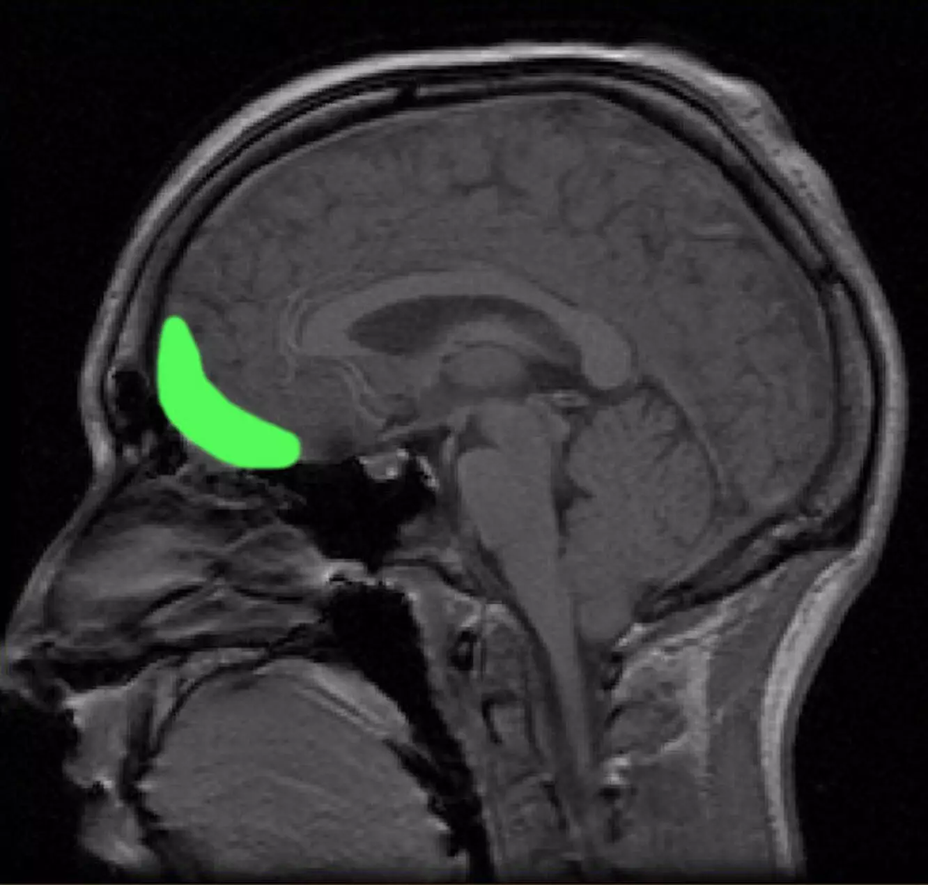 Orbitofrontal cortex